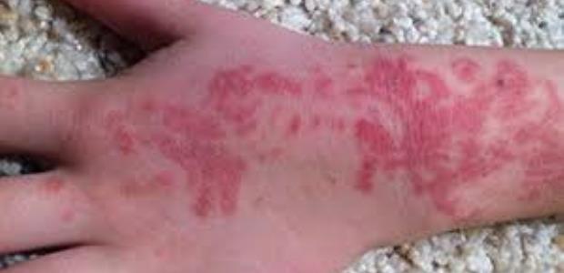 CPSC Revising ‘Strong Sensitizer’ Definition -- Occupational Health ...