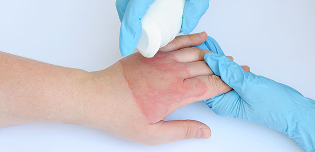 This Week is Burn Awareness Week -- Occupational Health & Safety